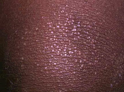 Dermatology: LICHEN NITIDUS